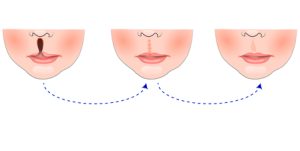 Cleft Lip & Cleft Palate Surgery : Oral & Maxillofacial Surgeons