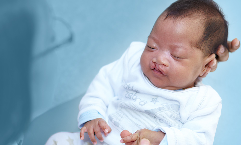 Cleft Lip Surgery in Ottawa - Argyle Associates